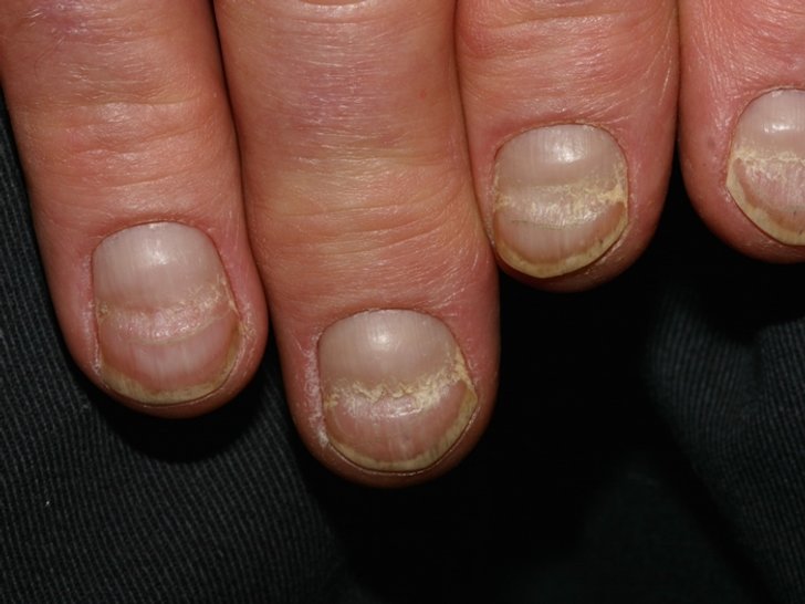 เล็บมีดอกขาว แปลว่าขาดสารอาหาร จริงหรือ?
