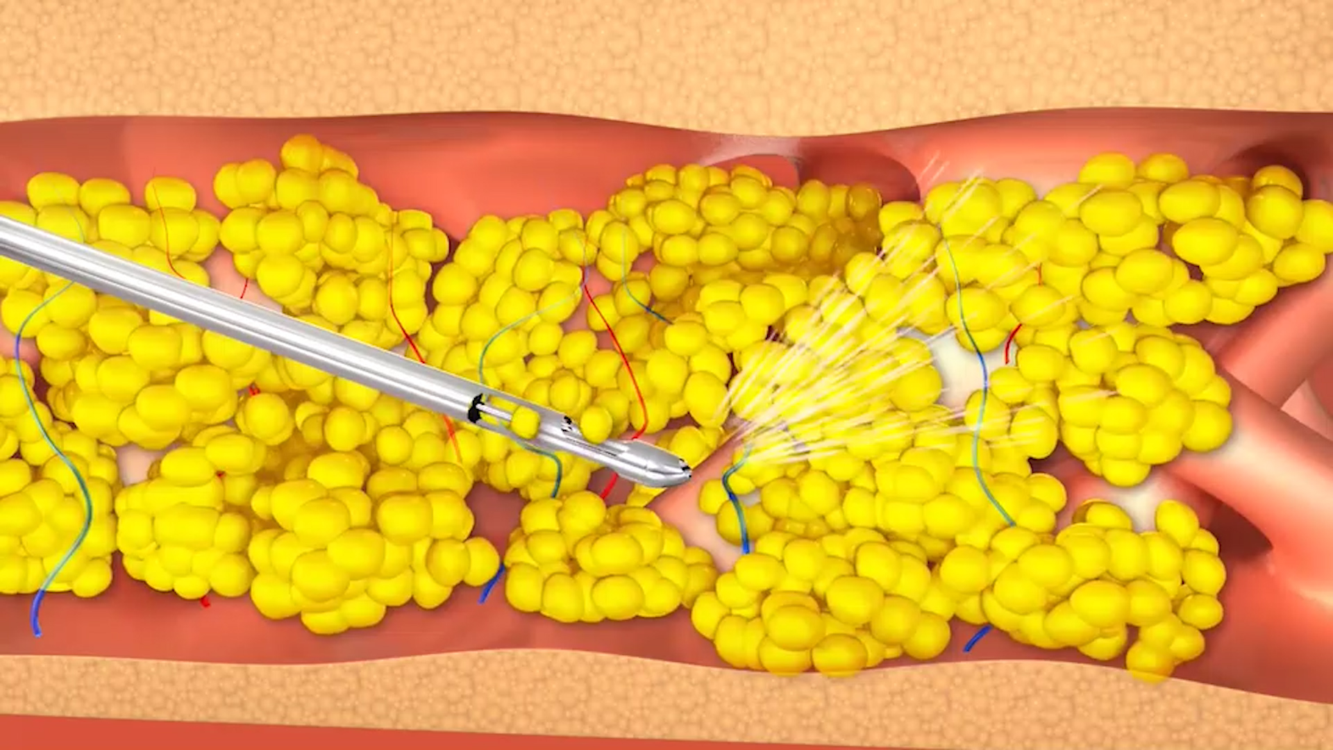 ศัลยกรรมเสริมหน้าอกด้วยเทคนิค “Fat Stem Cell”
